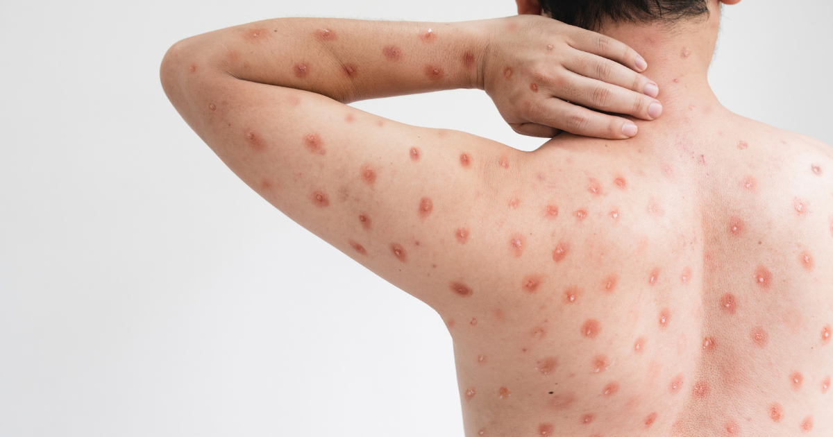 Nova cepa de mpox é confirmada no Brasil: veja o que se sabe até agora